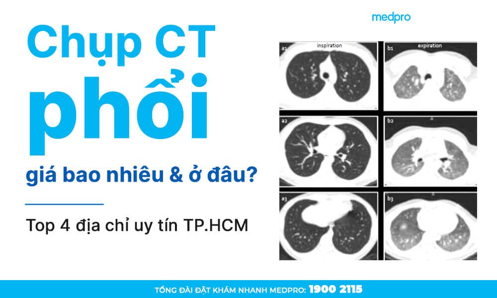 Chụp CT phổi giá bao nhiêu và ở đâu? Top 3 địa chỉ tại TPHCM
